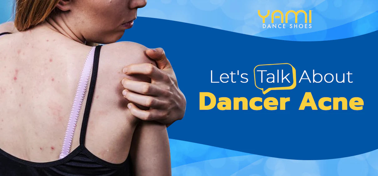 Let's Talk About Dancer Acne – Yami Dance Shoes